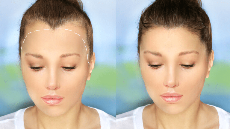 What Happens Before and After Forehead Reduction Surgery? - Stemsontx