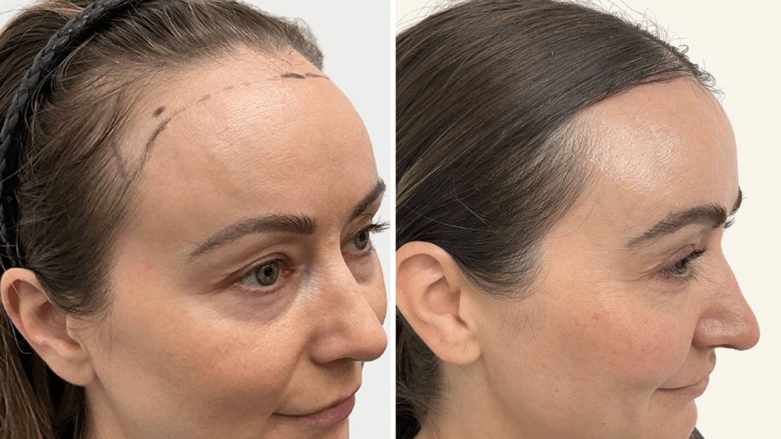 What Happens Before and After Forehead Reduction Surgery? - Stemsontx