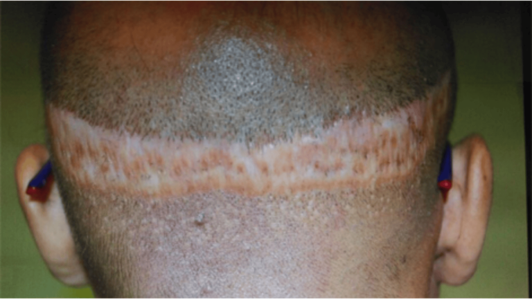Types of Hair Transplant Scars + How To Get Rid Of It - Stemsontx