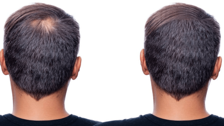 How to Identify Signs of New Hair Growth on Scalp - Stemsontx
