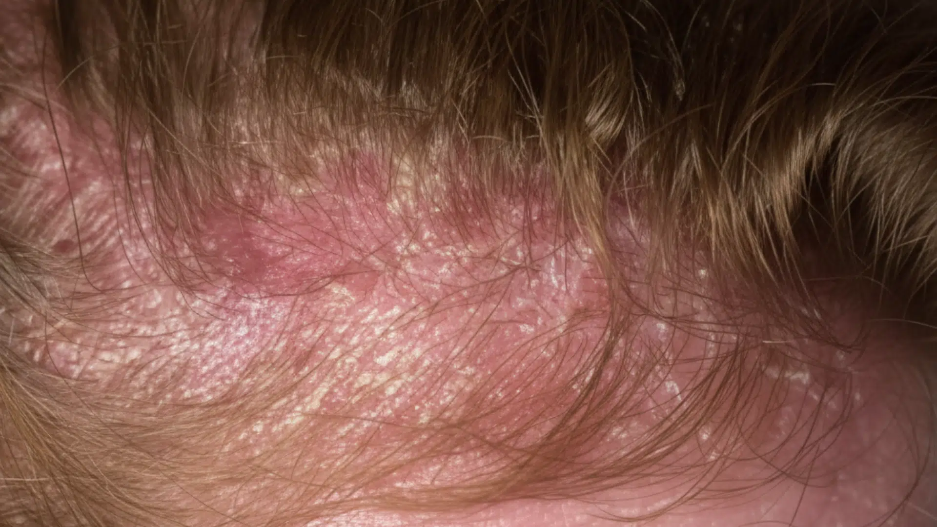 Scalp Inflammation: Signs, Causes and Easy Ways to Feel Better - Stemsontx